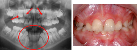 Impacted and ectopic canines | Bücco